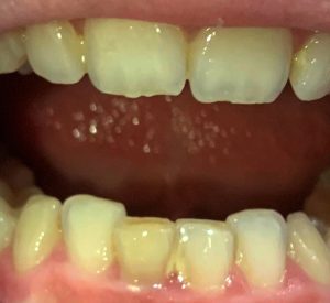 NECROSIS PULPAR: CUANDO MUERE UN DIENTE | iMAXDE