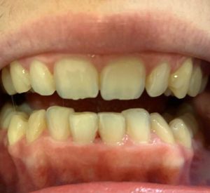 NECROSIS PULPAR: CUANDO MUERE UN DIENTE | iMAXDE